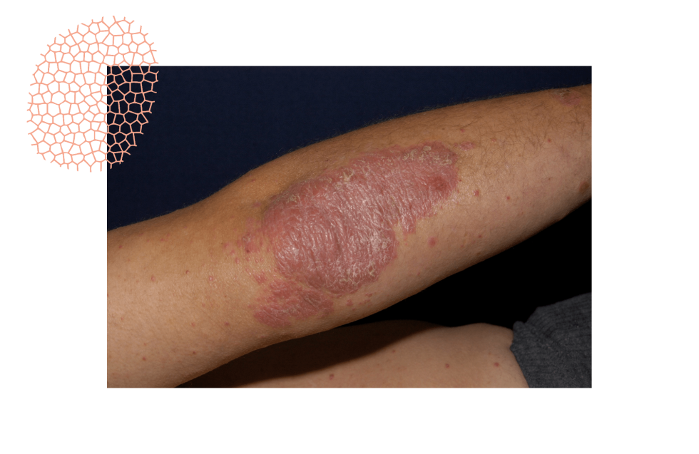 Lupénka | Dermatologie prof. Hercogové